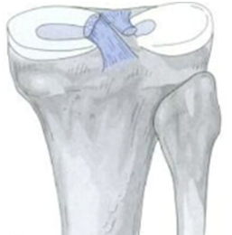 Menisco discóide | Pedipedia - Enciclopédia Pediátrica Online