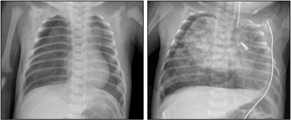 Radiografia de tórax no recém-nascido | Pedipedia - Enciclopédia ...