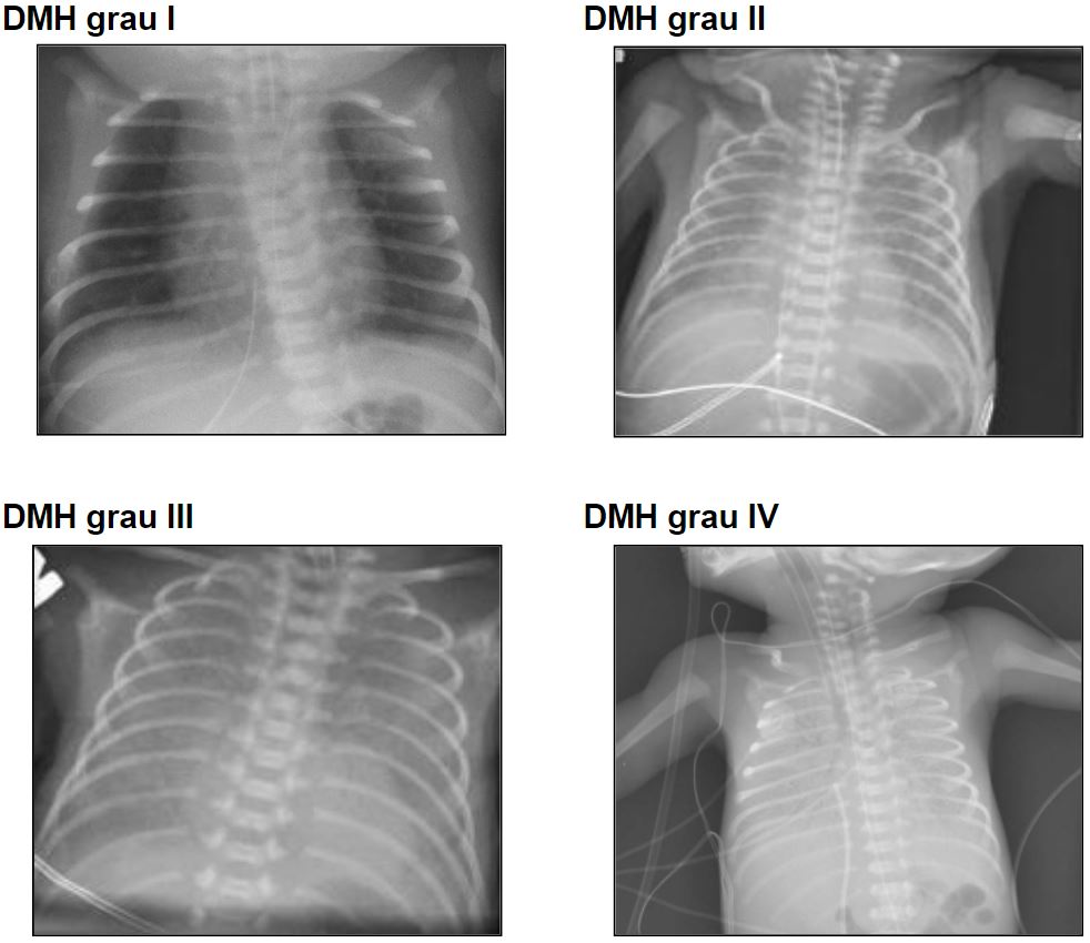 Radiografia de tórax no recém-nascido | Pedipedia - Enciclopédia ...